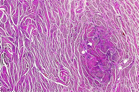 Human Cervical Ectropion Photograph By Science Photo Library Pixels Merch