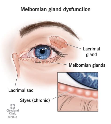 Meibomian Gland Dysfunction Symptoms And Treatment