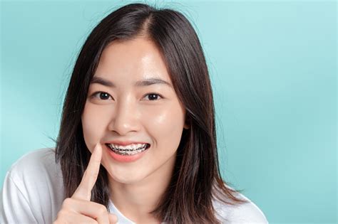 하얀 이빨로 중괄호를 입은 젊은 아시아 여성의 치과 중괄호는 파란색 배경 고립 된 스튜디오 샷 행복 십대 미소 표정에 대한 자신감을 증가시다 20 29세에 대한 스톡 사진