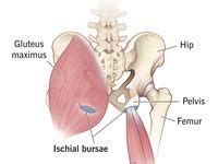 Ischial Bursitis