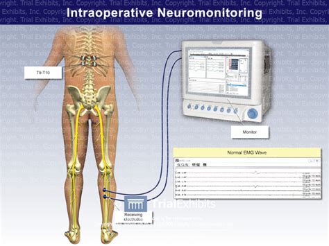 Intraoperative Neuromonitoring Trialquest Inc