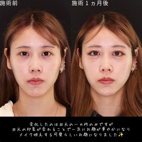 【タレ目形成＋目尻切開術】目の幅を広げて可愛いドール級アイに｜症例写真・ビフォーアフター｜美容整形･美容外科のtaクリニックグループ