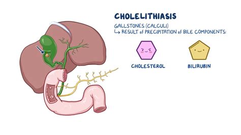 Video Cholelithiasis Nursing Osmosis
