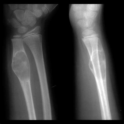 Simple Bone Cyst Pacs