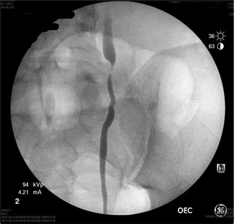 Retrograde Pyelogram Showing Extrinsic Narrowing Download Scientific