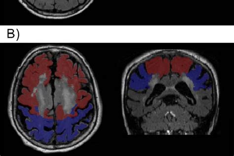 Example Of Segmentation Showing A The Temporal Region Green Where