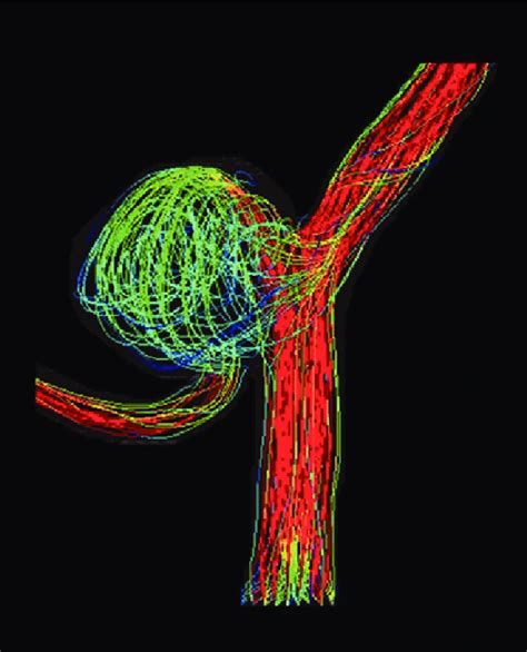 Computational Flow Dynamic Analysis Of Case 0 Red Lines Show The