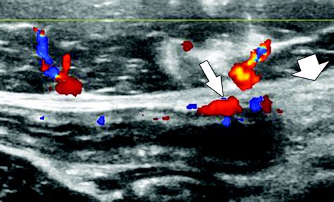 Lymphoid Hyperplasia Of The Appendix A Potential Pitfall In The