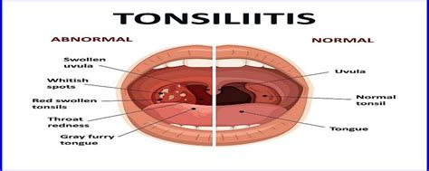 Can Allergies Cause Tonsillitis Ipkm