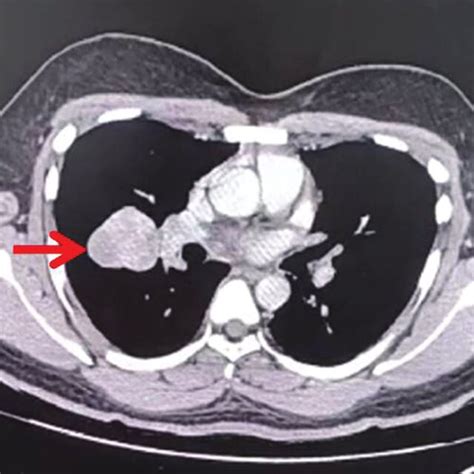 Contrast Enhanced Computed Tomography Thorax Showed Relatively Download Scientific Diagram