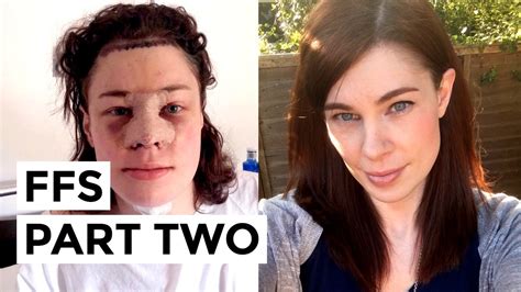 Transgender Ffs