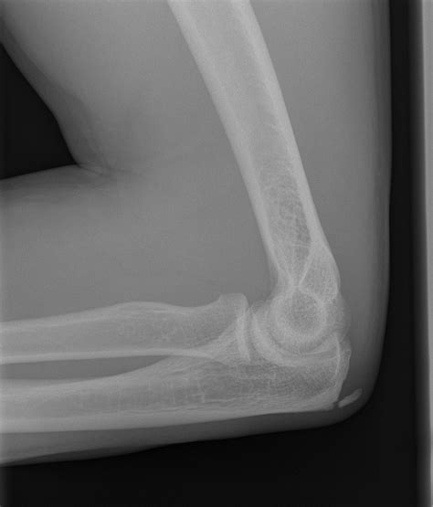 Elbow Olecranon Fracture Recovery Time At Ken Potter Blog