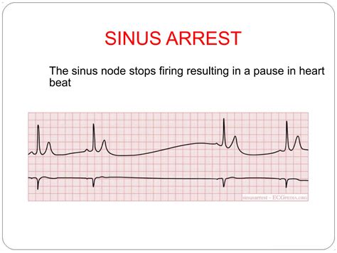 Sinus Node Dysfunction Pptx