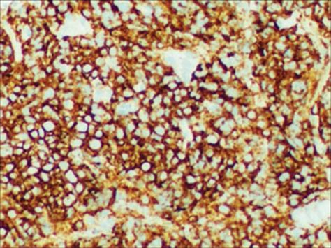 Allogeneic Hematopoietic Stem Cell Transplantation In A Patient With Hiv Negative Recurrent