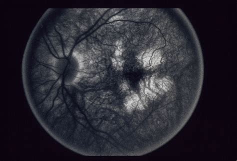 Pattern Dystrophy Retina Image Bank