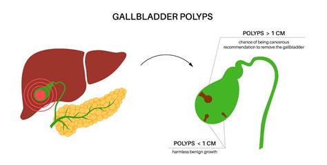 Gallbladder Polyp Anatomy Cabot Health