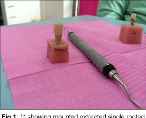 Figure 1 From Evaluation Of Root Debridement Skill In Periodontology