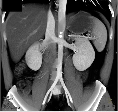 Sma Syndrome With Obstruction Of The Duodenum And The