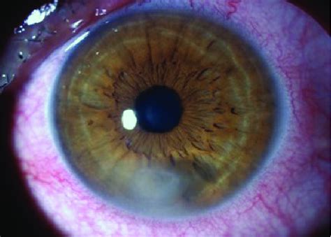 Persistent Epithelial Defect Download Scientific Diagram