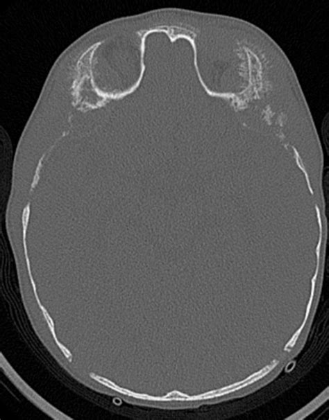 Neuroblastoma Skull Metastasis Radiology Case