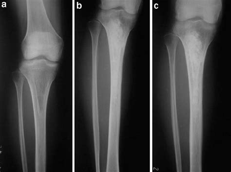 Radiographs Of A 19 Year Old Woman With An Intraosseous Lipoma In The Download Scientific