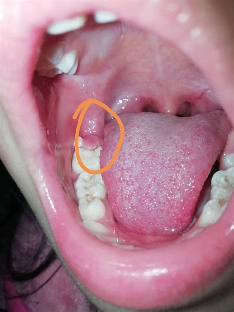 牙齿旁边长了肉坨图片 牙齿长息肉图片 伤感说说吧