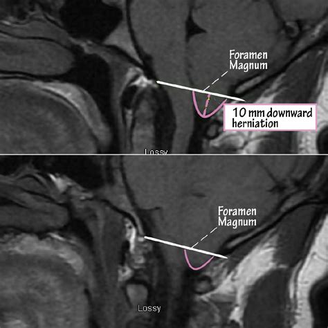 Foramen Magnum Mri Sagittal
