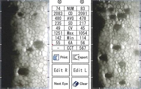 Fuchs Endothelial Corneal Dystrophy Beaten Metal To Rock