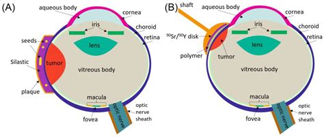 Current And Emerging Radiotherapy Options For Uveal Melanoma