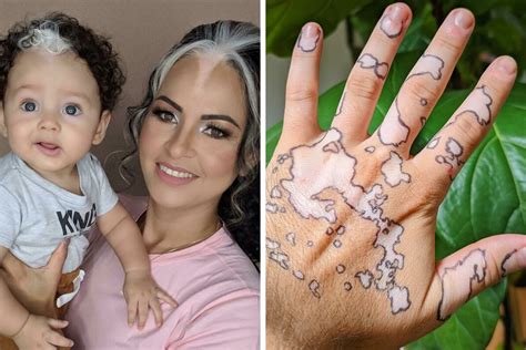 Genetic Mutation In Humans Examples