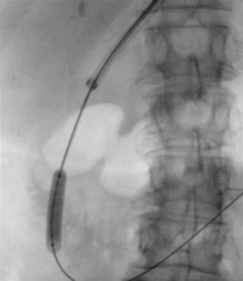 Percutaneous Transhepatic Cholangioscopy With Intraductal Electrohydraulic Lithotripsy For