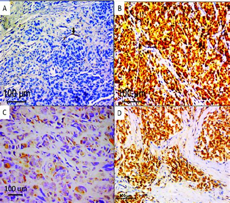 Braf V600e Immunohistochemical Staining In Melanoma A Negative