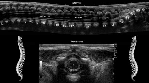 Neonatal Infant Spine Sonographic Tendencies