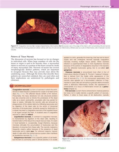 Patterns Of Tissue Necrosis