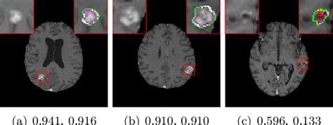 Figure 8 From Deep Learning For Brain Metastasis Detection And Segmentation In Longitudinal Mri