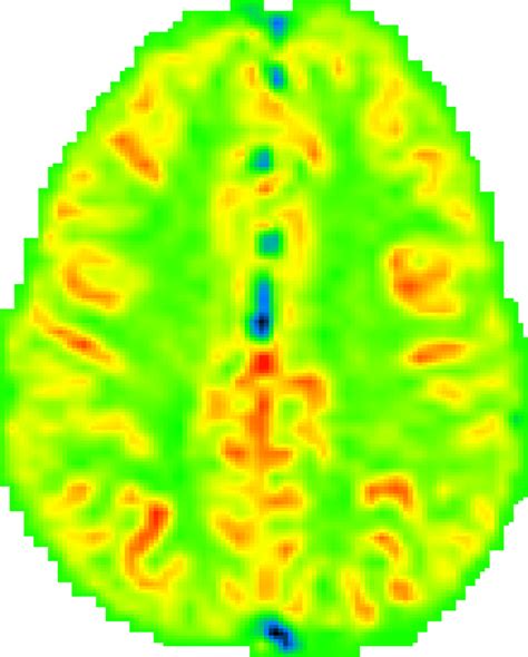 Comparison Of Perfusion And Bold Maps On Real Data For The Jde Top