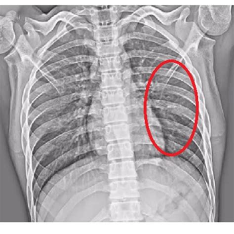 Cxr Chest X R Ay Showing Fractures Of Left 6 Th 7 Th And 8 Th Ribs Download Scientific