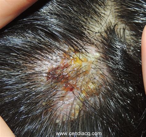 ⁉️qué Es El Querion De Celso⁉️ Dr Miguel Ordóñez Taco