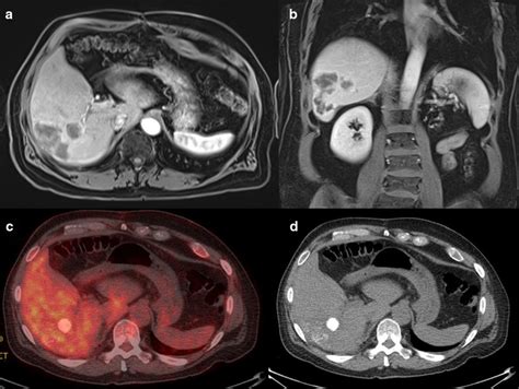 Post Radioembolization Response A B 1 Month Post Radioembolization
