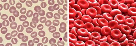 Hypervolemia Symptoms And Treatment Healthy Food Near Me