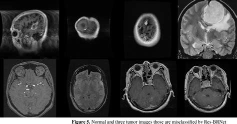 Figure 1 From Brain Tumor Mri Classification Using A Novel Deep