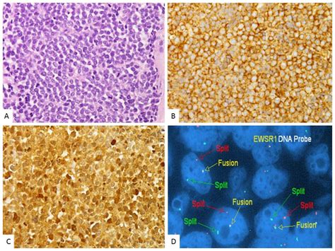 Primary Pure Endometrial Primitive Neuroectodermal Tumors With Ewsr1