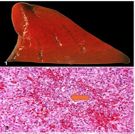 Lec 41 Liver 5 Flashcards Quizlet