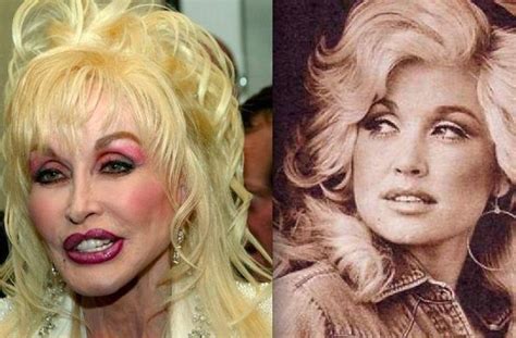 Dolly Partons Plastic Surgery The Many Procedures She Had Done