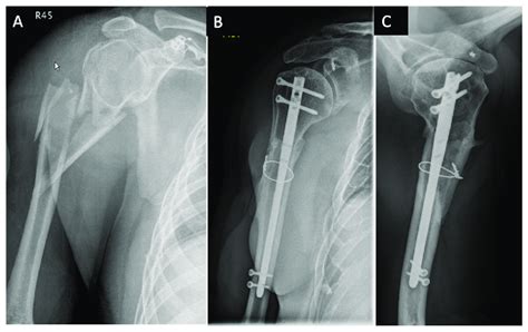 Example Of Surgical Treatment With Nailing And A Metaphyseal Cerclage