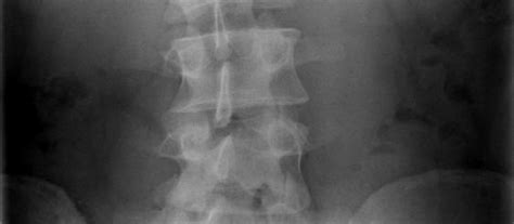 Navigating Adult Degenerative Scoliosis A Guide To Healthy Aging