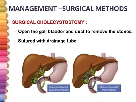 Cholelithiasis Pptx