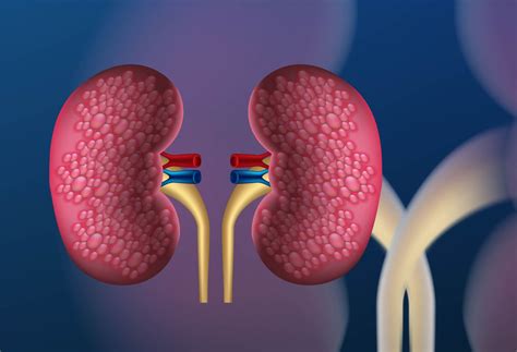 Kidney Stone Treatment A Urologist S Guide FeM Surgery