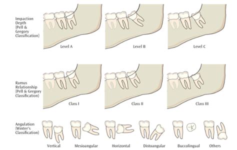 Classification System Of Impacted Mandibular 3rd Molar Pell 46 Off