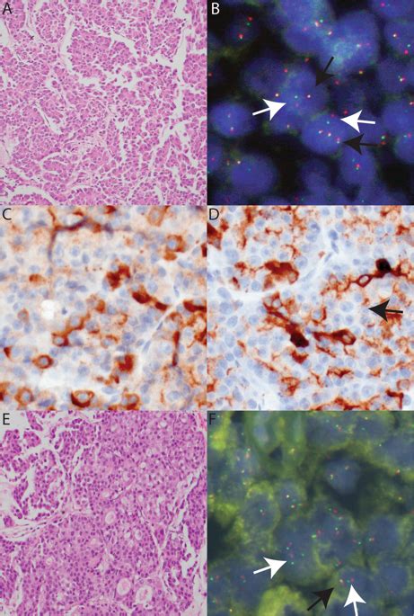 Ret 基因重排发生在胰腺腺泡细胞癌的一个亚群中。 Modern Pathology X Mol